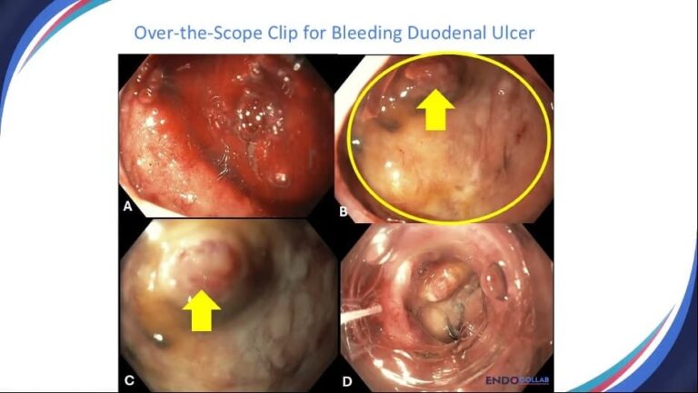 Endoscopic Tips And Tricks: First-Line Monotherapy With Over-The-Scope ...
