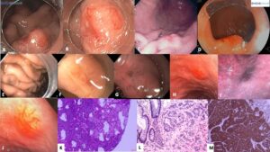 Gastric Neuroendocrine Tumors: Classification, Endoscopic Features ...